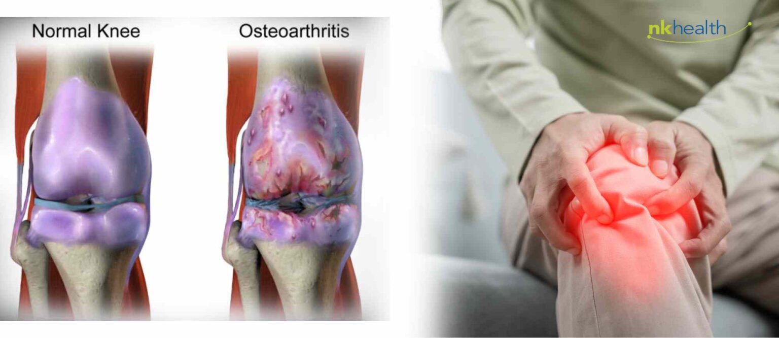 Fisioterapi Lutut Osteoarthritis - Klinik NK Health